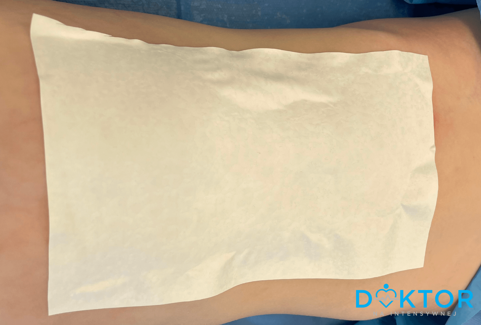 Leczenie oparzeń u dzieci - Doktor na Intensywnej